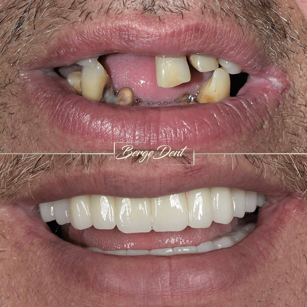 Bergedent Esthetic Dentistry And Implantology - Dentist Turkey